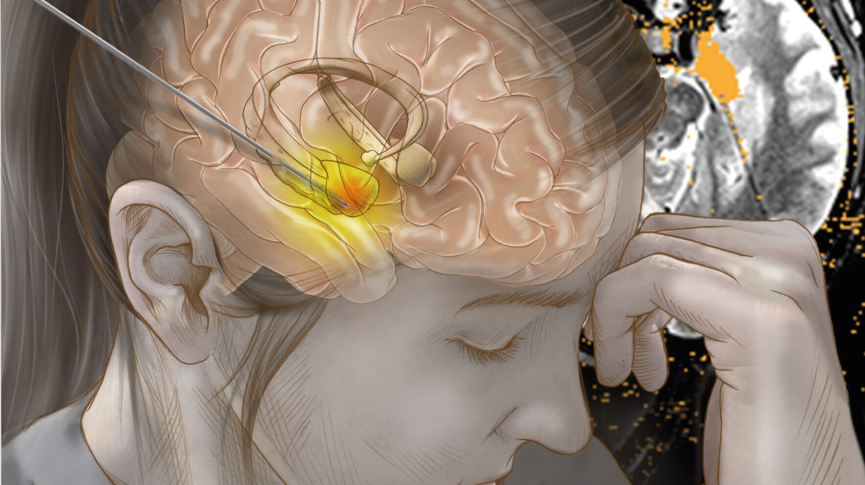 Cross-Post — Neurosurgery Publishes Updated Return-to-Play ...